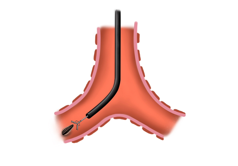 气管镜取异物法（3）_琦琦xue-站酷ZCOOL