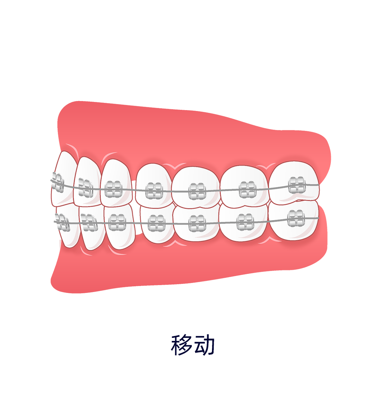 牙齿矫正过程_蜀文途话-站酷ZCOOL