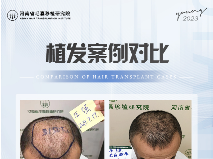 头发种植案例对比_落日余晖lsl-站酷ZCOOL