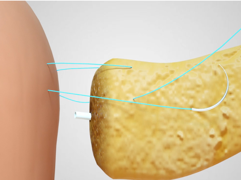 同济胰腺缝合_兰奈尔Lanelle-站酷ZCOOL