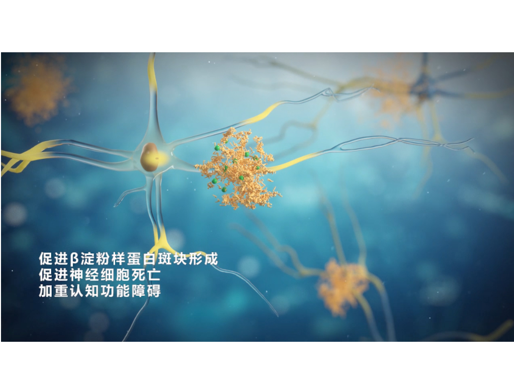 阿尔兹海默病（上海第九人民医院口腔医学院）_兰奈尔Lanelle-站酷ZCOOL