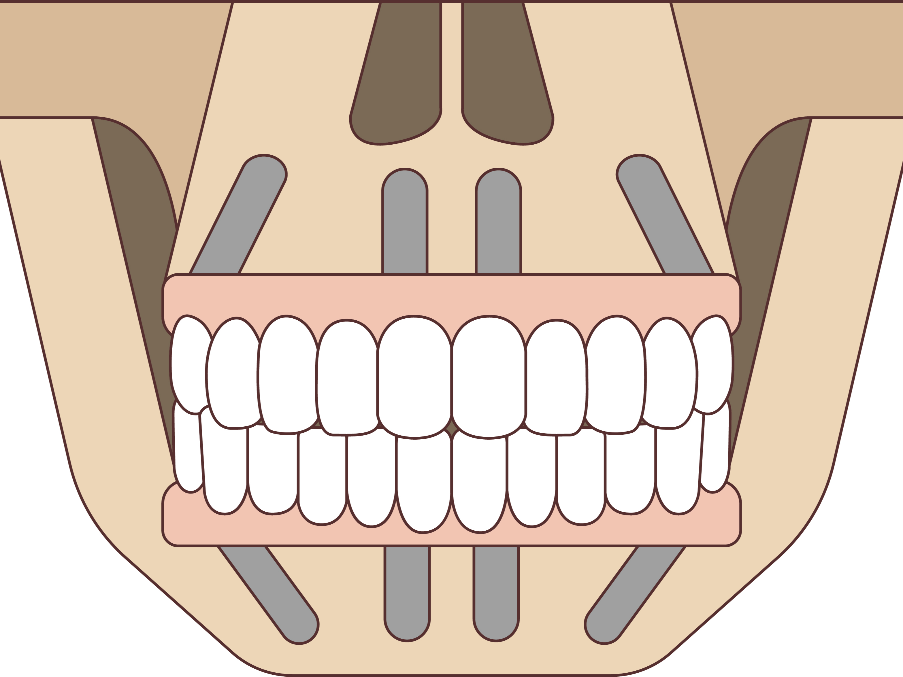 All-on-4全口种植牙 口腔牙齿插画_想想都开心-站酷ZCOOL